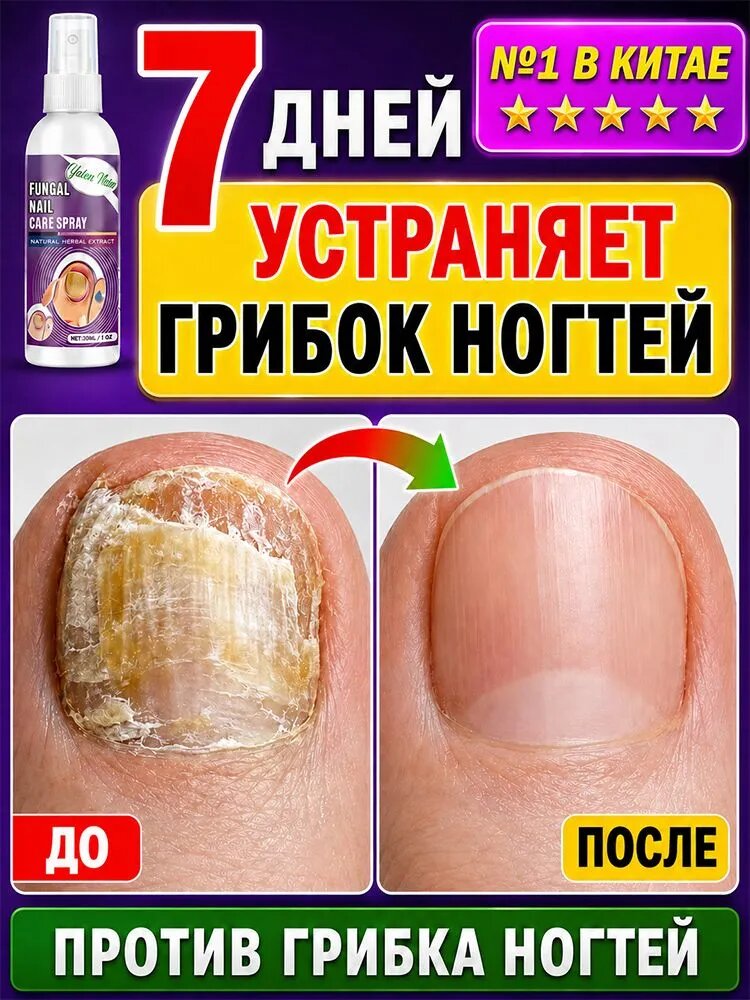 Лечебный спрей от грибка, эффективен при лечении грибковых инфекций и шелушении ногтей, устраняет неприятный запах и зуд, улучшает внешний вид поврежденных ногтей, мягкие ингредиенты, 30 мл.