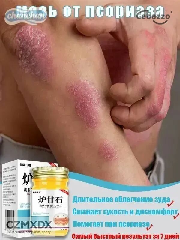 Негормональная мазь от псориаза, дерматита, экземы, нейродермита и грибковых заболеваний, 50 г без гормонов от грибка от нейродермита