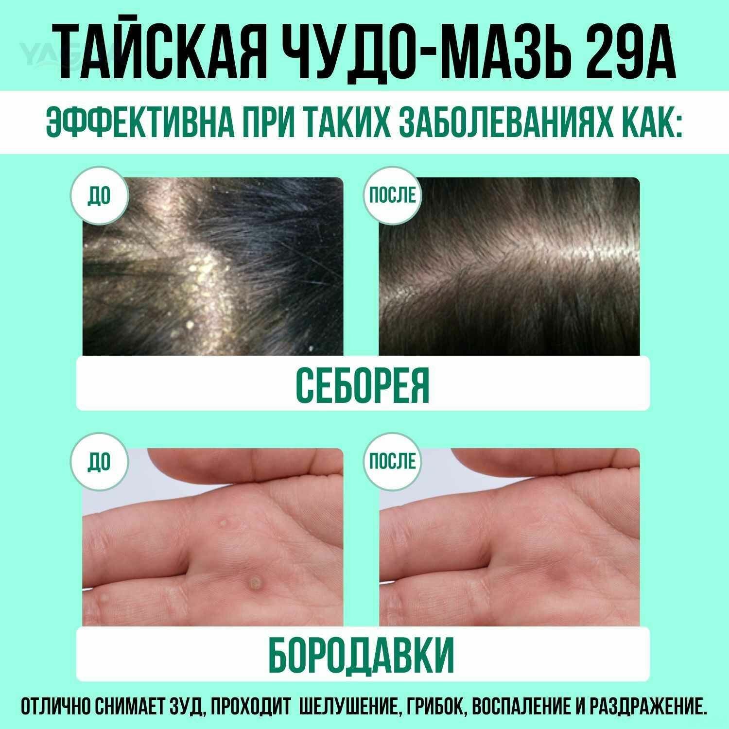 Мазь от псориаза экземы и грибка ногтей на ногах. Тайский бальзам для ухода за кожей 29А, 15 гр YAGUA