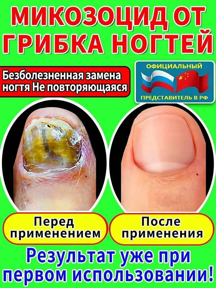 Противогрибковая мазь Ноготок от грибка ногтей на ногах и гиперкератоза, противогрибковое средство для ног, укрепляйте и восстанавливайте ногти