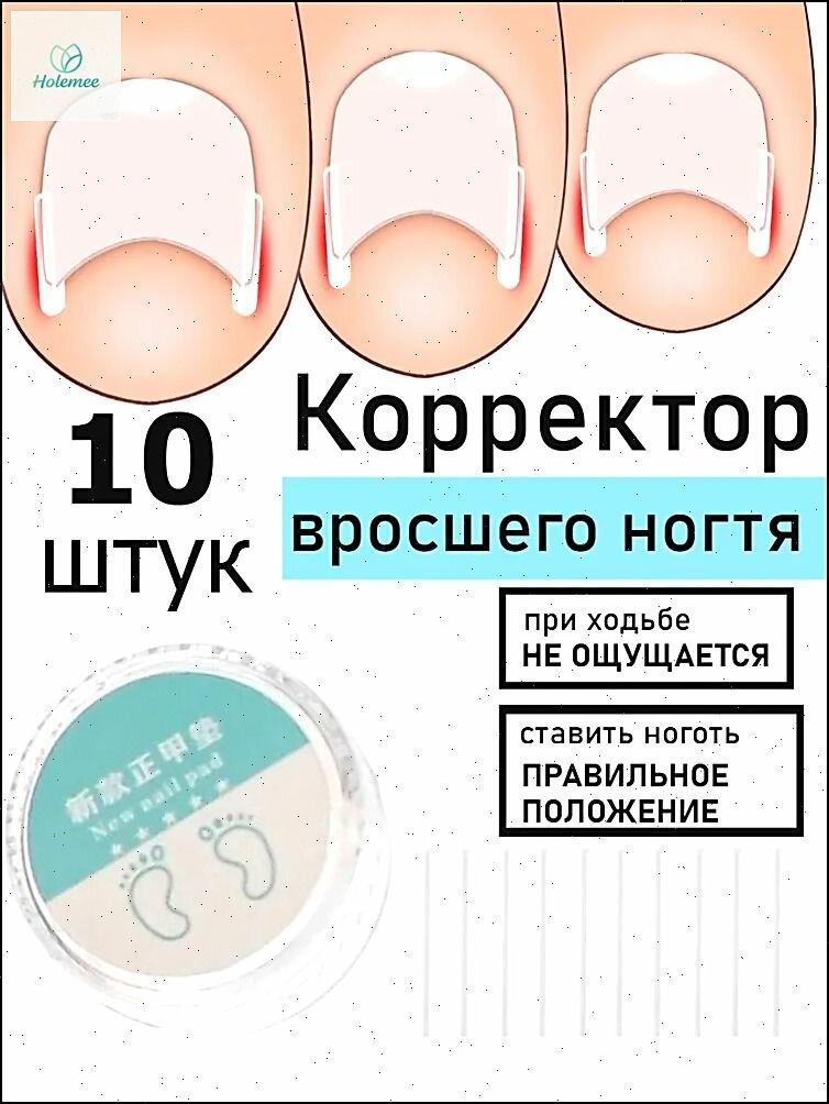 Брекеты Для Вросших Ногтей, Лечение Вросших Ногтей, Облегчение Боли