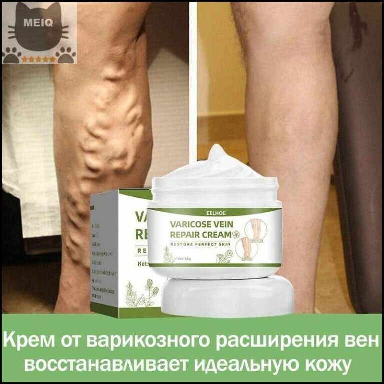 Крем для лечения варикозного расширения вен 50г Эффективное средство для снятия отечности ног, варикозного расширения вен, усталости и боли