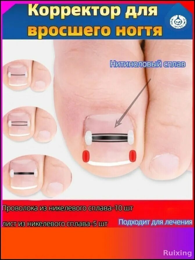 Эксклюзивный набор 8 корректоров из никелидтитана против вросших ногтей