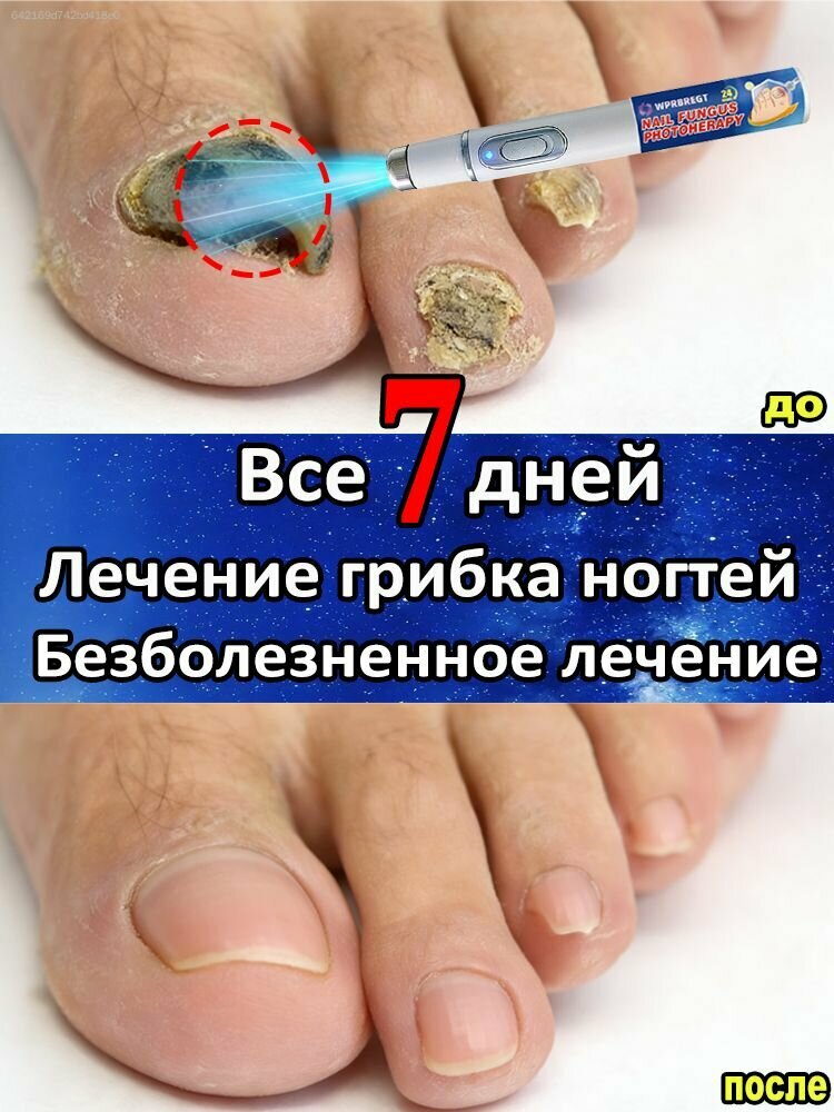 Лазерная указка, используемая для лечения грибка ногтей. Безболезненно удаляет стойкие ногти на ногах и грибок. Подходит для восстановления и ухода за ногтями. одна лазерная ручка против грибка восстановление ногтей для ногтей