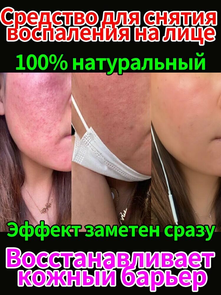 Мазь от Китайский розацеа на лице купероза и покраснений