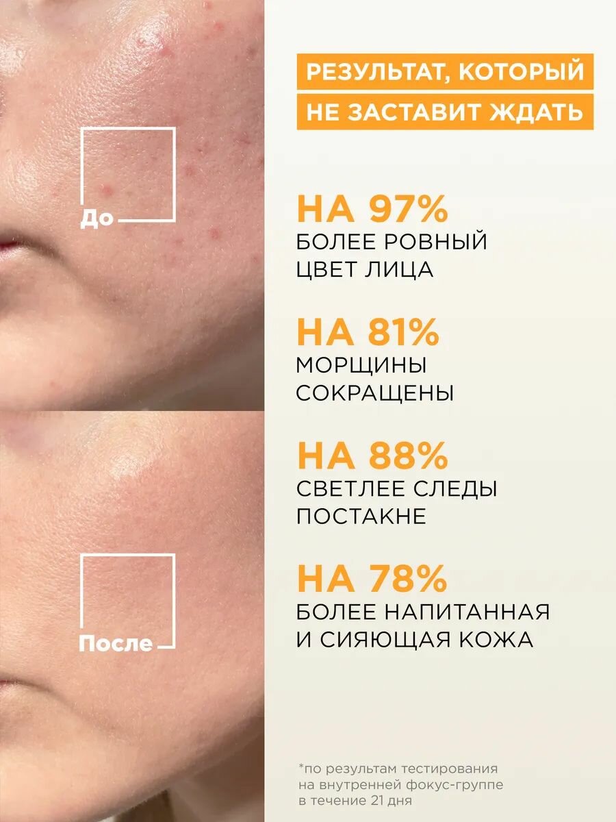 Набор сывороток для лица от прыщей, с витамином C и ниацинамидами