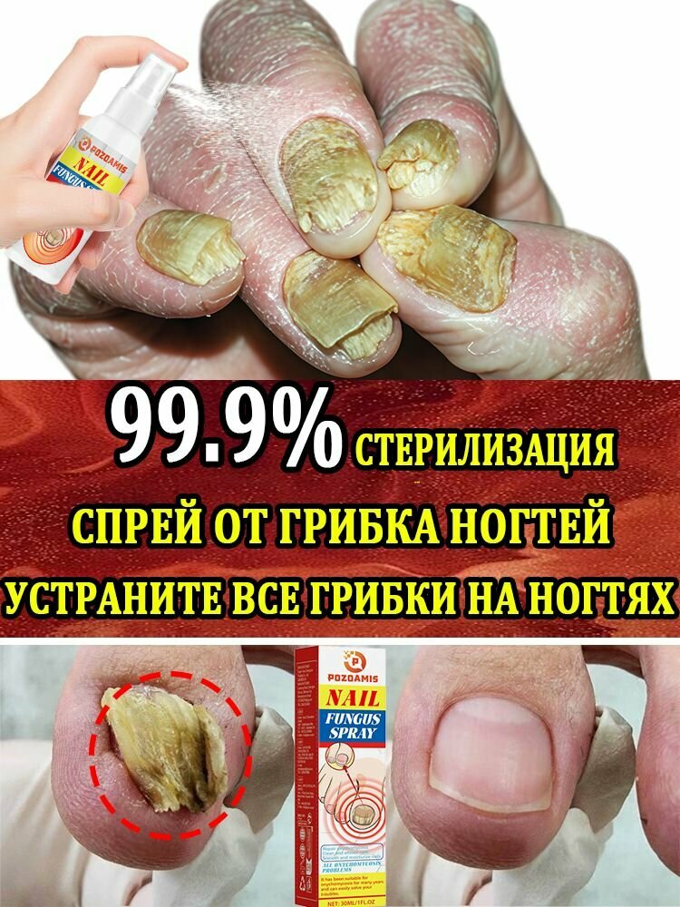 Спрей, используемый для лечения грибка ногтей. Быстро удалите все грибки с ногтей на ногах в течение 7 дней. Он подходит для восстановления и стимулирования роста.30 мл