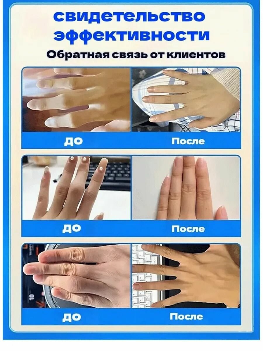 Мазь от артроза суставов пальцев рук и узелков Гебердена и Бушара