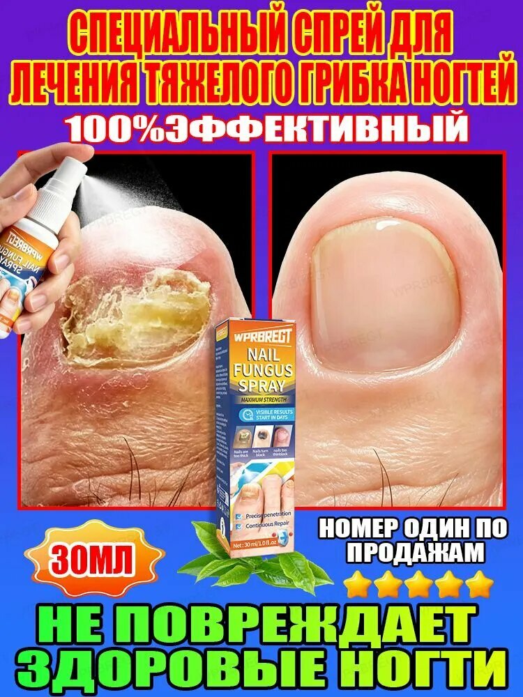 Спрей для лечения грибка ногтей, подходит как для рук, так и для ног, быстродействующее средство для ухода за ногами.