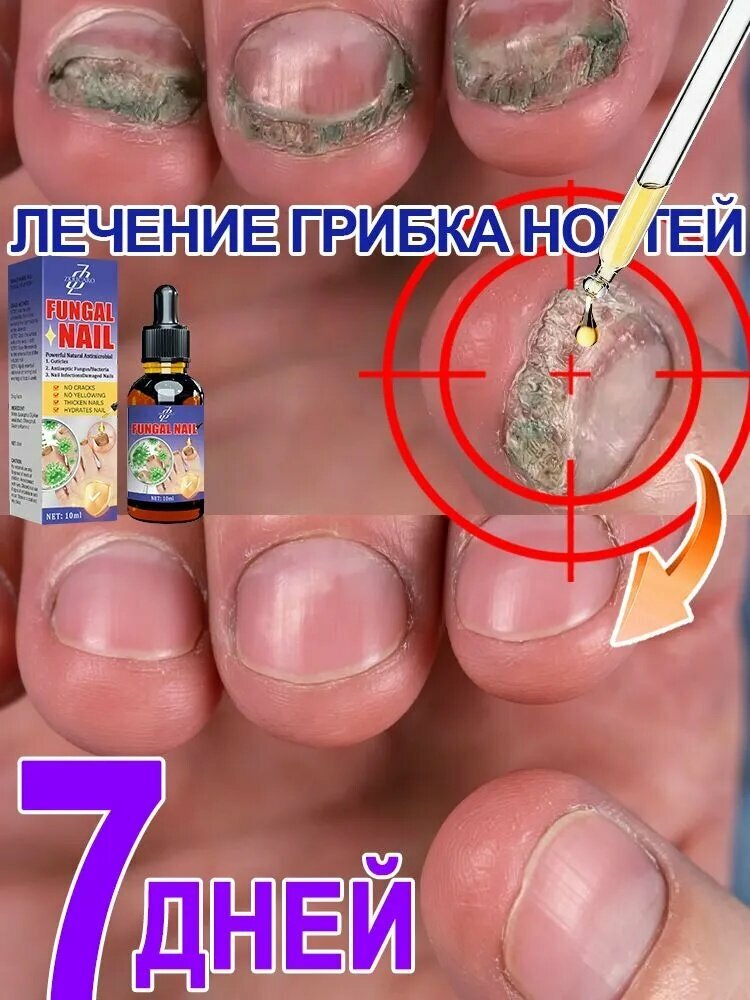 Эссенция от грибка ногтей. Очистите корни от грибка онихомикоза и проведите лечение онихомикоза. Маникюр, крепкие ногти.3 бутылка
