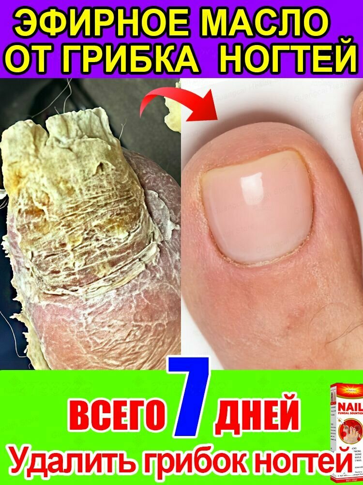 Эфирное масло от грибка ногтей уничтожает грибок, восстанавливает здоровье ногтей, убирает желтение и трещины Наносите на поврежденные ногти , чтобы вернуть им естественный вид и прочность 10 мл