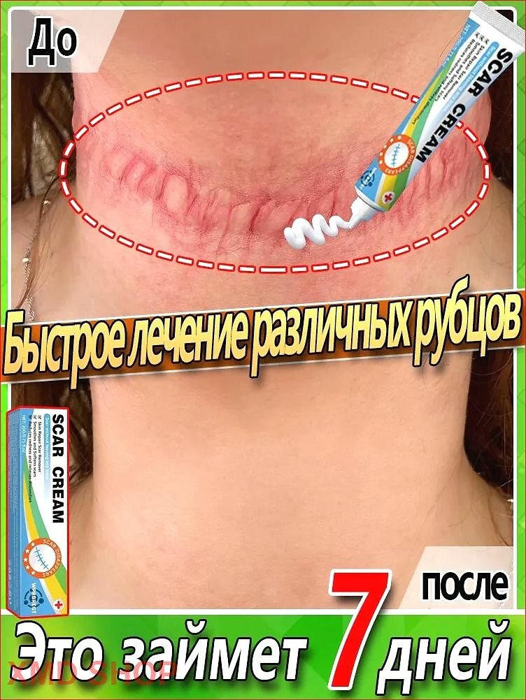 Этот крем от шрамов эффективно лечит различные виды рубцов, включая рубцы от угревой сыпи и растяжки, и предотвращает их повторное появление. Может использоваться на любой части тела. 20 грамм.