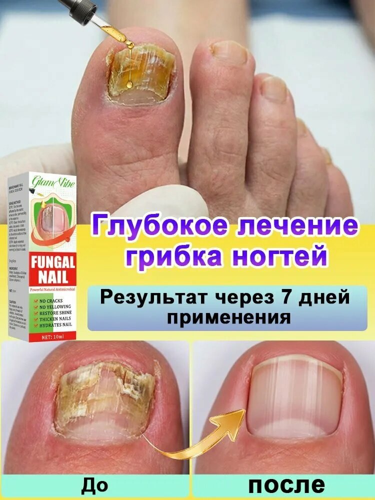 Сыворотка для лечения грибка ногтей: Лечит грибковые инфекции, борется с шелушением и растрескиванием ногтей, а также обеспечивает восстанавливающий уход за ногами.10 мл