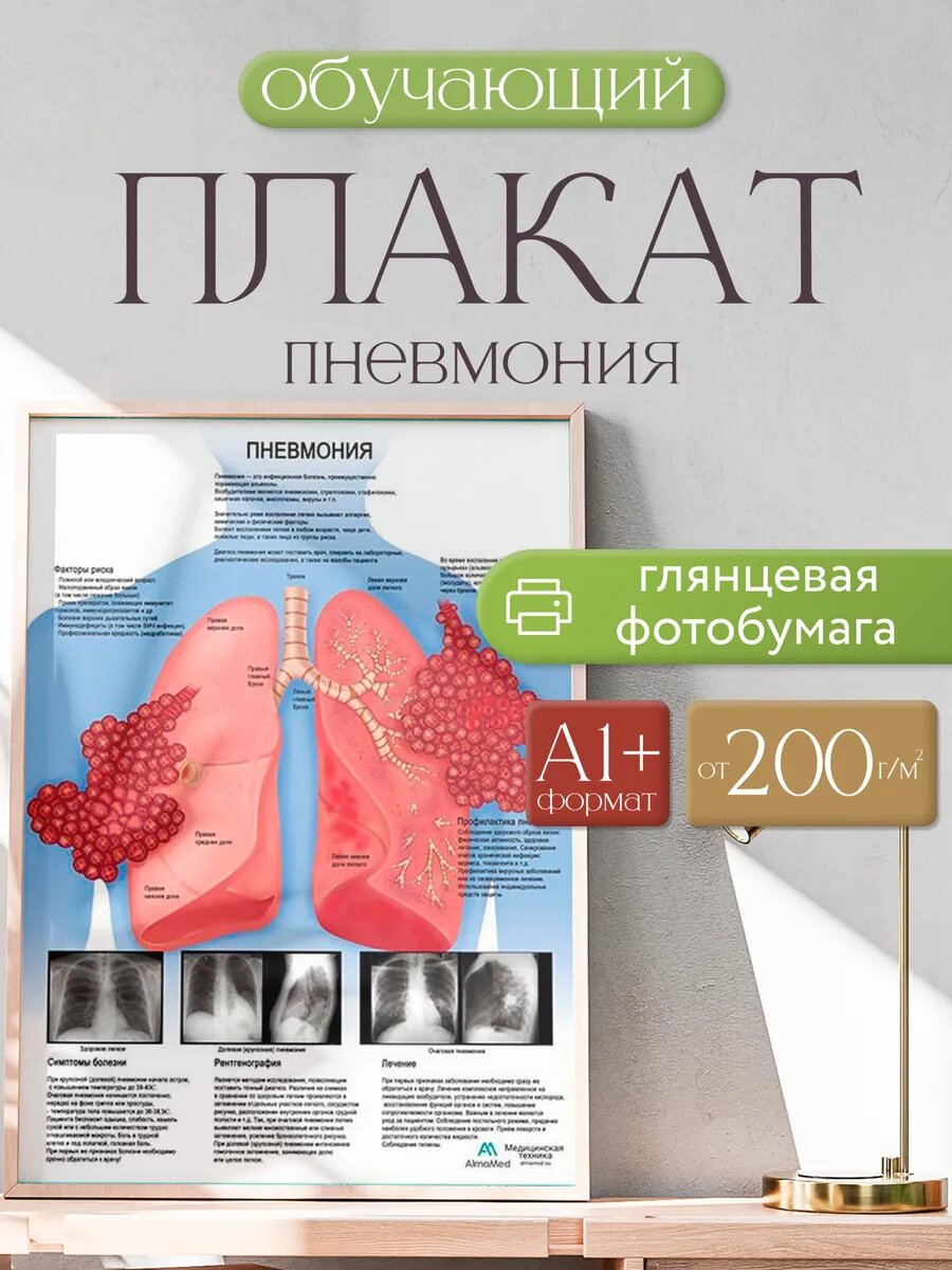 Пневмония, плакат, глянцевая фотобумага от 200 г/кв. м, размер A2+