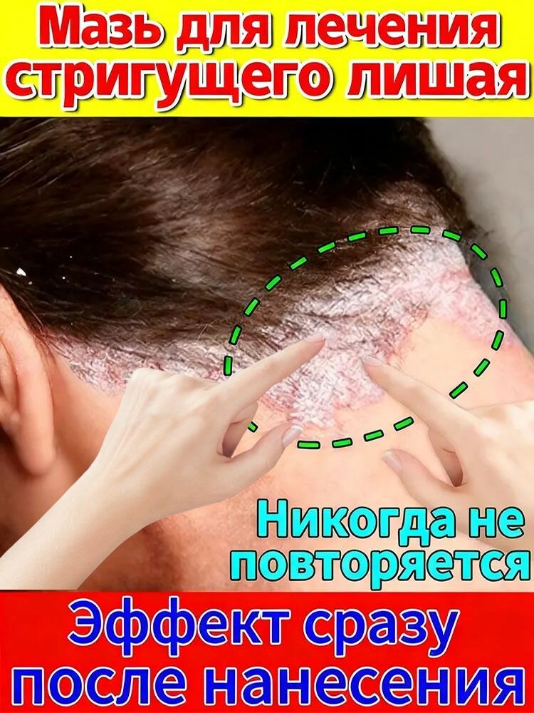 Мазь для лечения псориаза кожи головы с быстрым эффектом