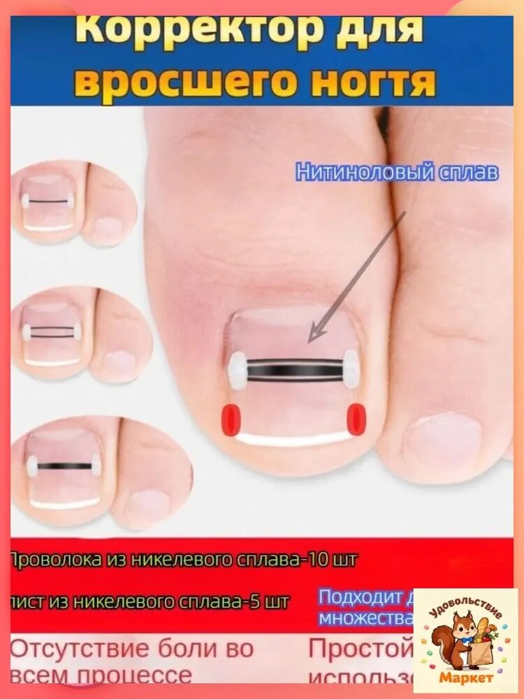 Комплект из 10+5 никелид-титановых корректоров для вросших ногтей