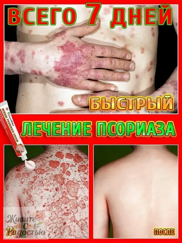 Мазь для лечения псориаза, экземы, дерматита, лишая, угревой сыпи, прыщей, способна быстро снять раздражение и покраснение кожи,20г