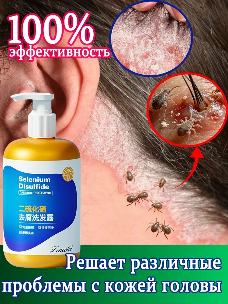 Шампунь от перхоти лечебный, для нормальных и жирных волос, лечит зуд и себорейный дерматит, восстанавливает поврежденные волосы,300 мл