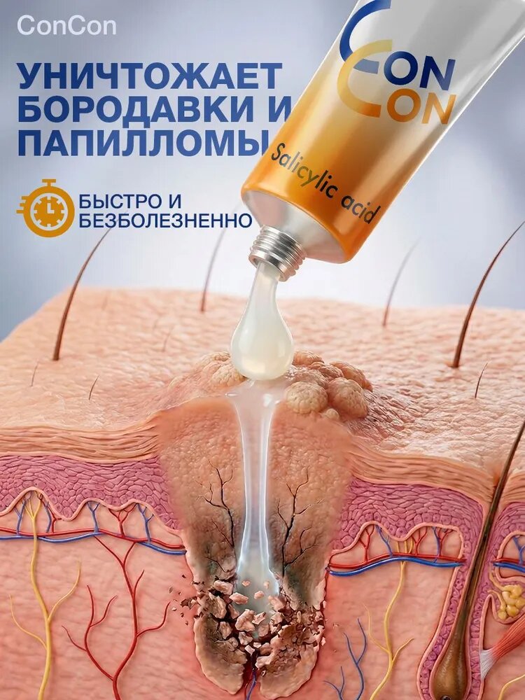 От папиллом Con Con / Крем от бородавок, чистотел от папиллом, для тела, для рук, для шеи, чистотел от бородавки, от сухих мозолей, Undofen от бородавок / 30 мл