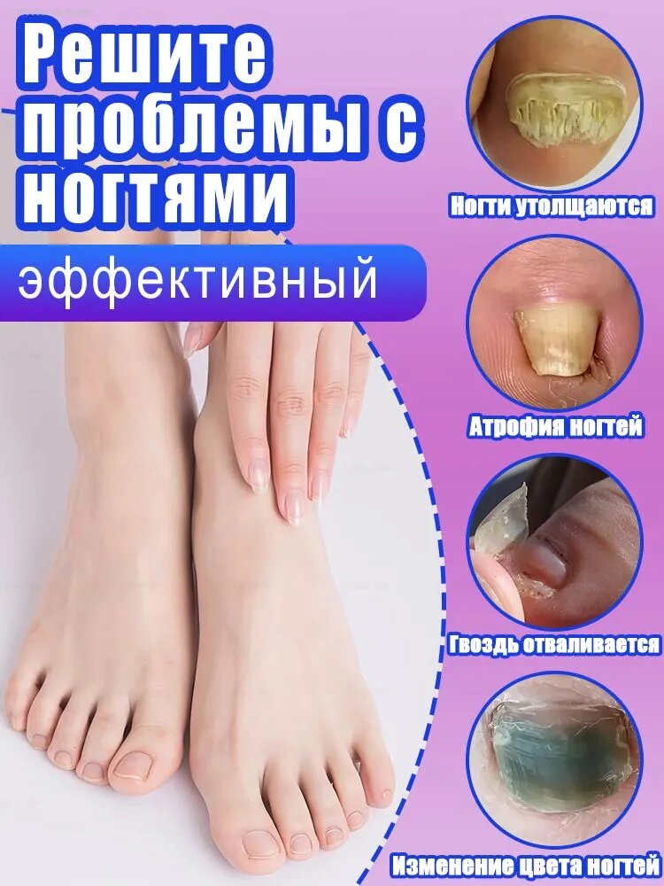 Специальный спрей от грибка ногтей, используемый для удаления пораженных ногтей, устранения зуда и неприятного запаха, смягчения кератина и безболезненной профилактики инфекции.30 мл.