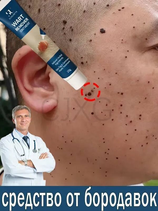 7 дней без следов удаление Мазь от бородавок, для рук, для шеи, чистотел от бородавки, от сухих мозолей 20 мл