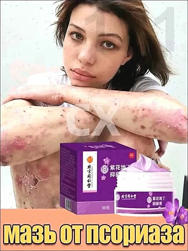 Мазь от псориаза Негормональная мазь от зуда для лечения псориаза, дерматита и экземы, порезов, облегчения зуда, 20 г.