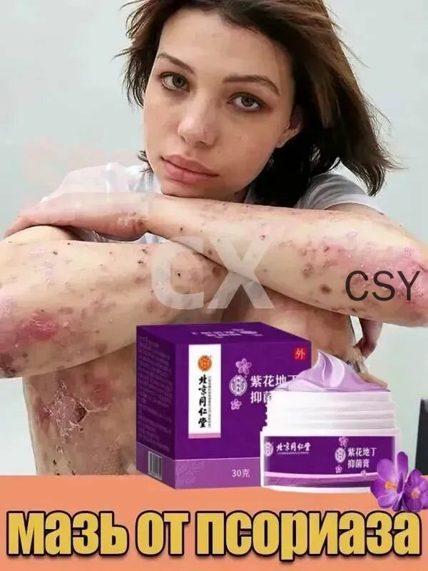 Мазь от псориаза Негормональная мазь от зуда для лечения псориаза, дерматита и экземы, порезов, облегчения зуда, 20 г.