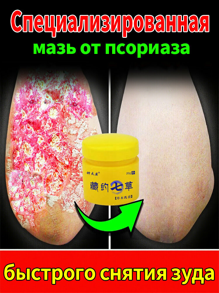 Мазь от псориаза, экземы, дерматита, грибка для снятия зуда 20