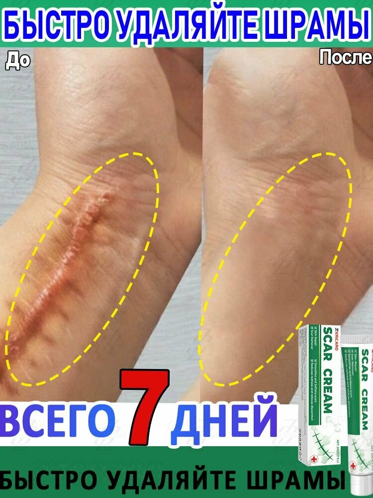 Крем от рубцов Крем от растяжек, подходит для беременных женщин. Эффективно лечит рубцы, растяжки, угри, кожные поражения и пигментацию. Подходит для лица и тела. 100 мл.