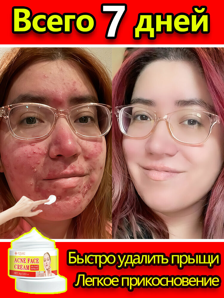 Крем от прыщей точечный/против прыщей, от акне комедонов угрей черных точек, средство для подростков, для проблемной кожи, себорегулирующий.30мл