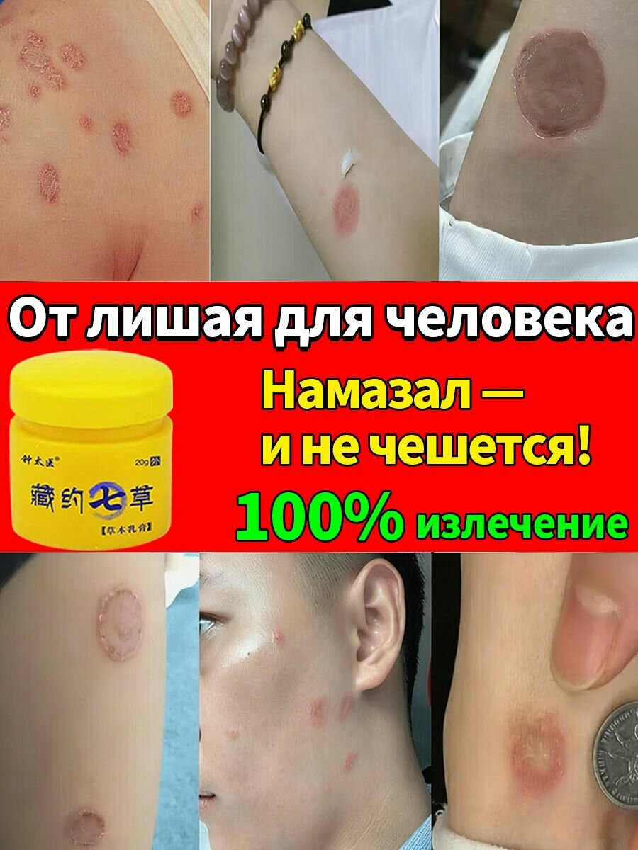 Мазь от лишая на теле у человека