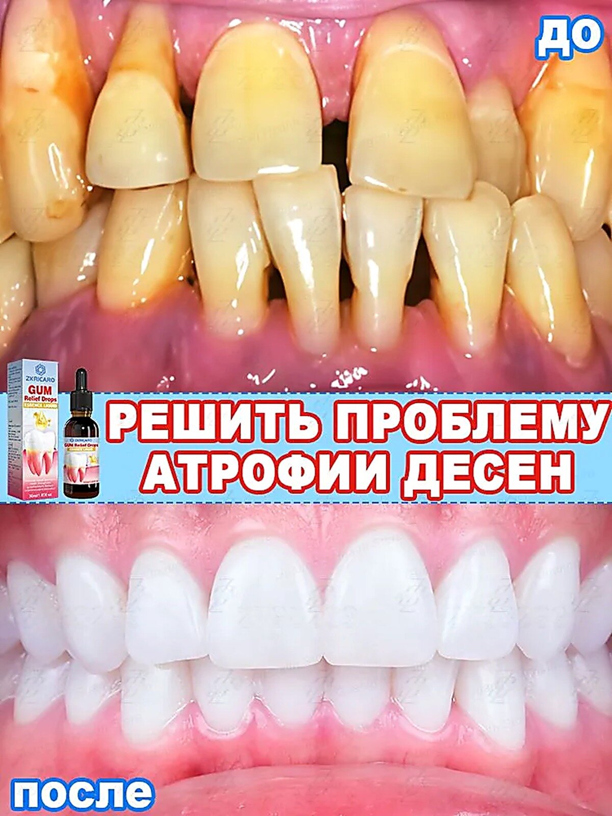 Масло для ухода за полостью рта при рецессии десен, повышенной чувствительности зубов, стоматите и для ухода за деснами. Укрепляет зубную эмаль.30 мл