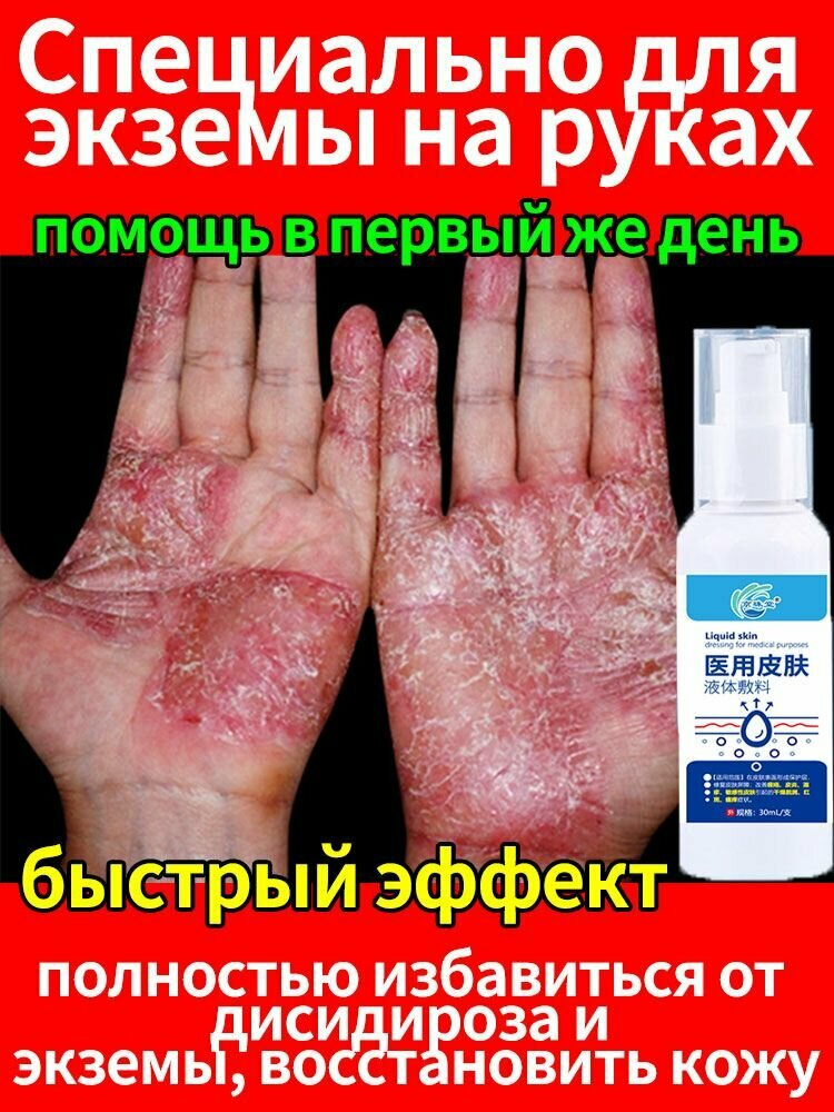 Мазь против зуда, подходит для лечения псориаза, экземы, нейродермита, грибковых инфекций, дерматита и себорейного дерматита
