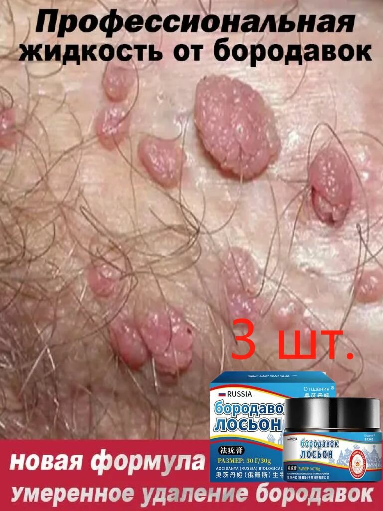 Папилофаг, Крем от папиллом и бородавок, средство для удаления новообразований, чистотел, Китайская травяная мазь, отсутствие побочных эффектов 30г