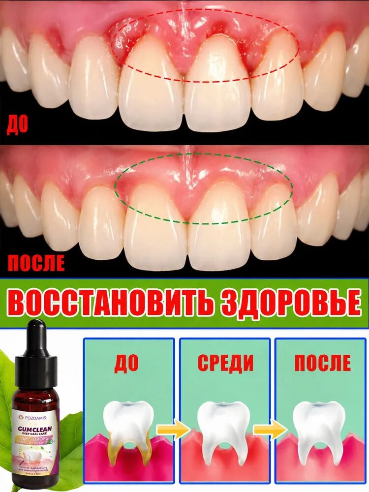 Используется для лечения пародонтита, стоматита, снятия чувствительности и отека десен, восстановления, профилактики и укрепления поврежденных десен, Гигиена полости рта 30 мл.