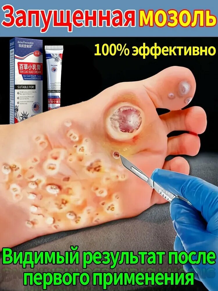 Mазь от мозолей стержневых и натоптышей , Крем от сухих мозолей, шипицы, бородавок, натоптышей,20 г.