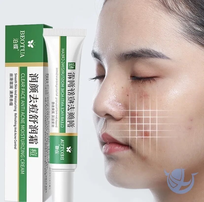 Крем для лечения акне угрей/От прыщей для проблемной кожи лица угревой сыпи/Лечение шрамов удаление пятен от прыщей акне/Уход за проблемной кожей