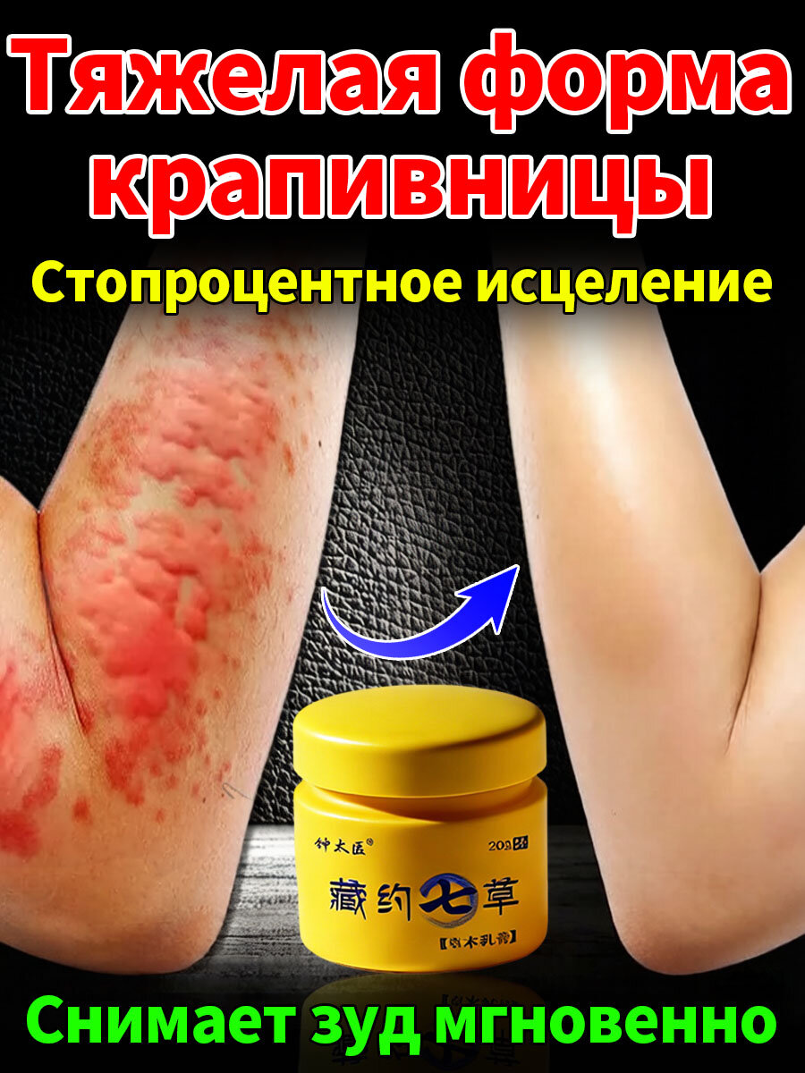 Мазь от крапивницы для взрослых и детей: быстрое снятие зуда, отека и сыпи на коже. Комплексное лечение всех видов аллергической крапивницы (острой и хронической).
