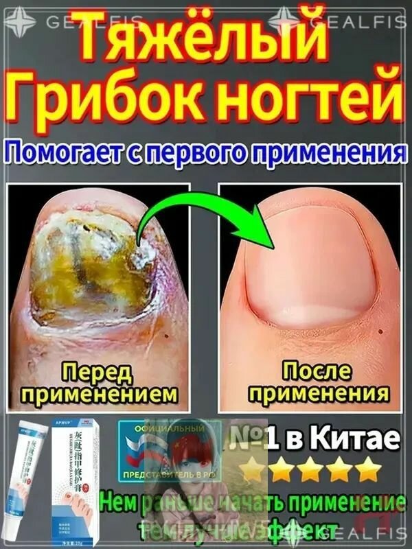 Мазь ноготок от грибка ногтей на ногах, Лечите грибковые инфекции, укрепляйте и восстанавливайте ногти и рого