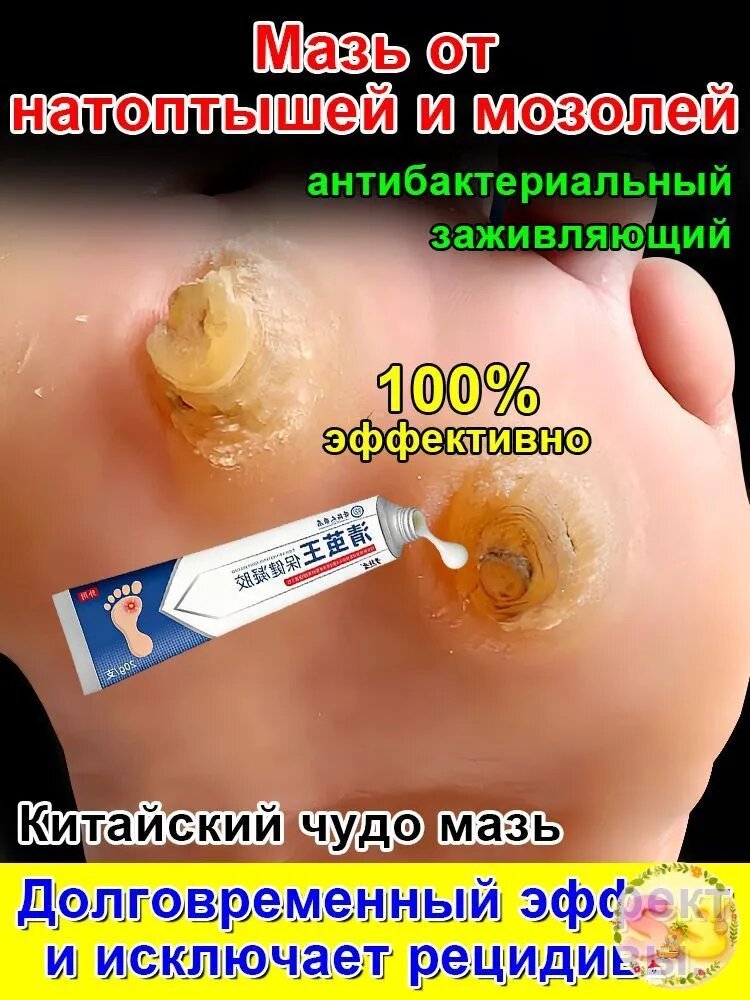 Mазь от мозолей стержневых и натоптышей , Крем от сухих мозолей, шипицы, бородавок, натоптышей,20 г.2шт