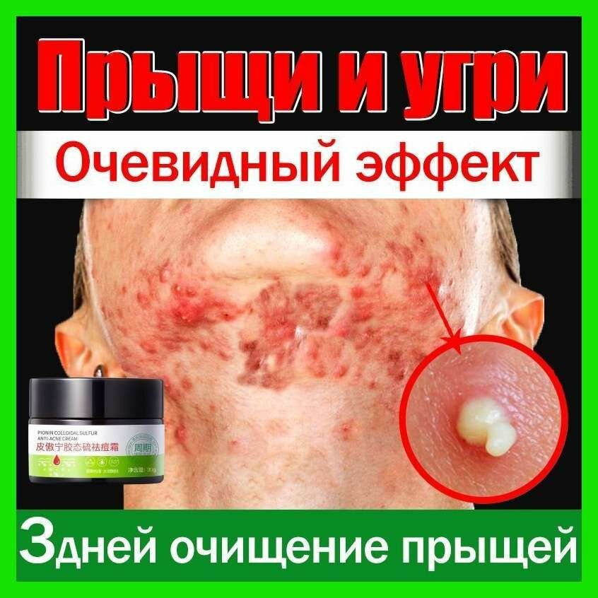 Цинковая паста, крем от прыщей на лице, для лица и тела против угрей, прыщей, акне. от прыщей увлажняющая, заживляющая, точечное средство для подростков и взрослых 30 г.