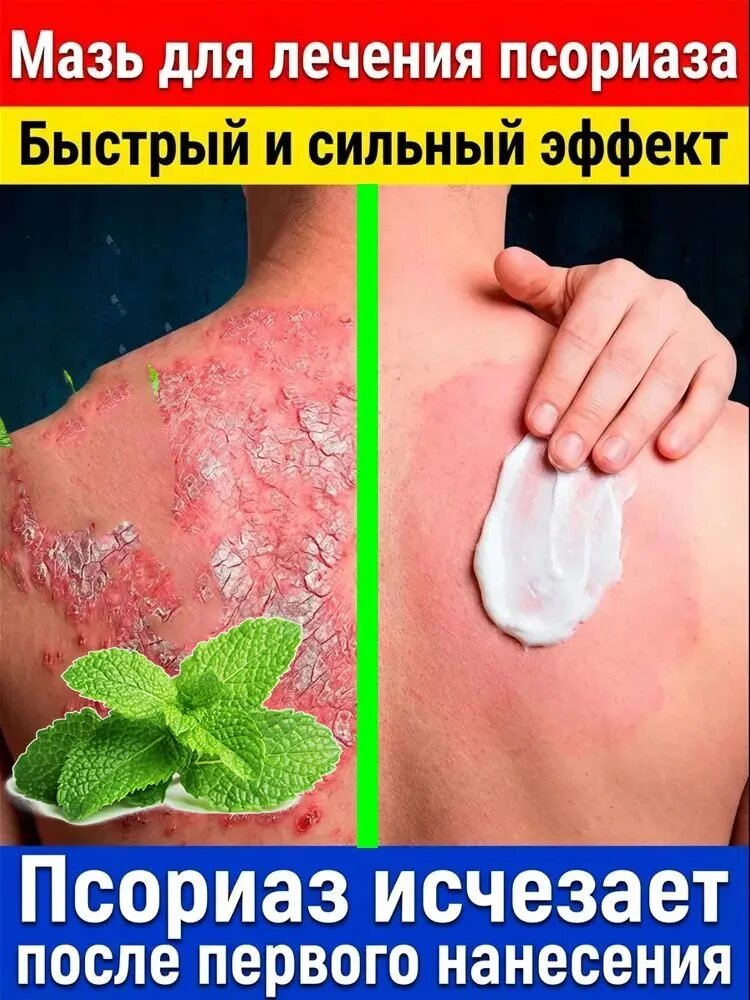 Крем от псориаза,20 г, Негормональное средство от прыщей, постакне, грибка, атопического и себорейного дерматита, шелушений, зуда , Нафталановый крем.