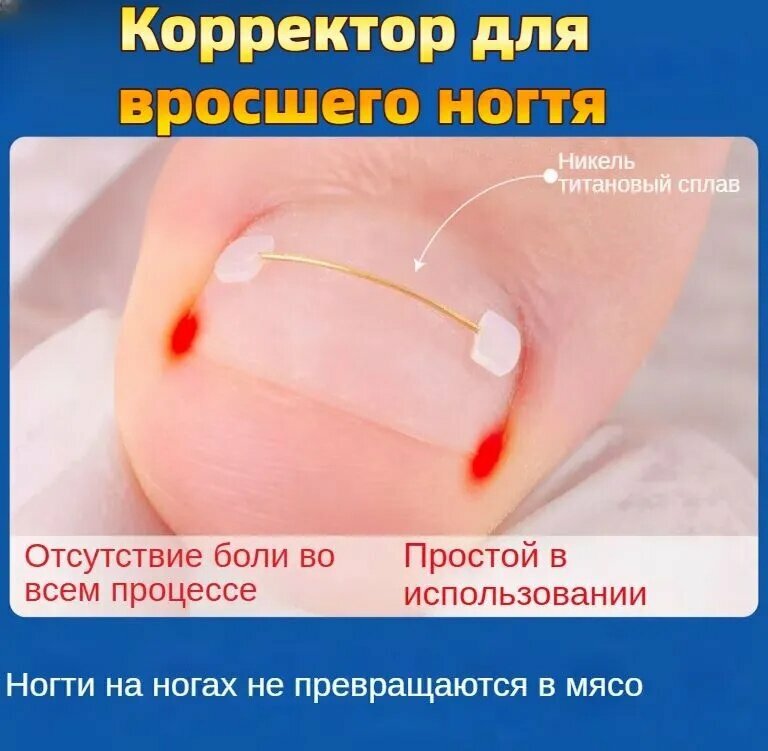 Набор из 10+5 нитиноловых корректоров для вросших ногтей