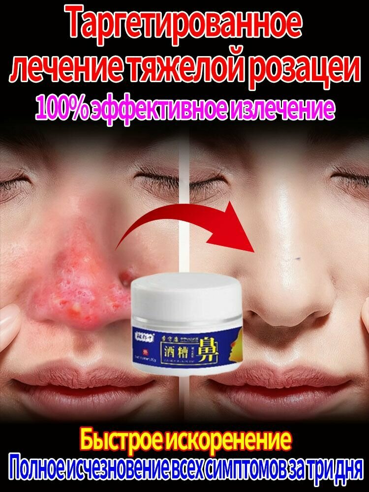 Мазь от розацеа на лице купероза и покраснений