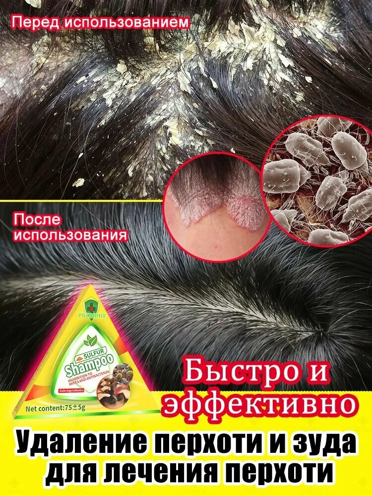 Твердое мыло-шампунь, подходит для лечения выпадения волос, жирной кожи головы и перхоти, снимает зуд, себорейный дерматит, содержит натуральные экстракты, 75 грамм