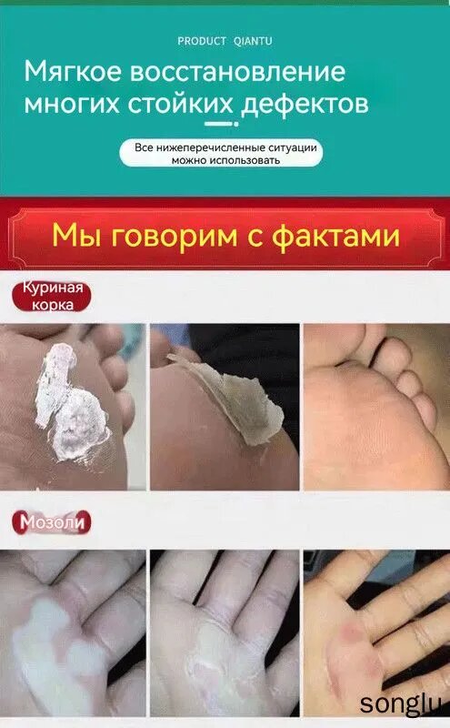 Пластырь от мозолей, бородавок и натоптышей лечебный, быстрое смягчение, безболезненное удаление,20 г 1 шт.