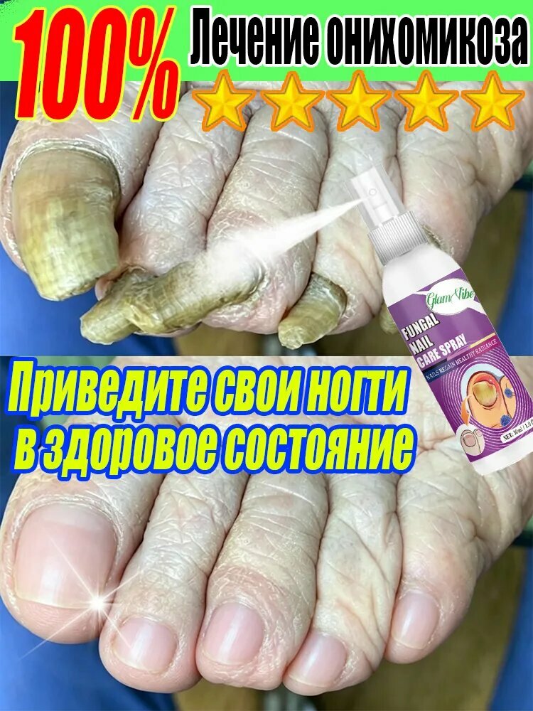 Спрей для лечения, укрепления и восстановления грибковых инфекций ногтей на ногах и ногтях на руках. Лечит онихомикоз, подавляет рост грибков и способствует здоровому росту ногтей.