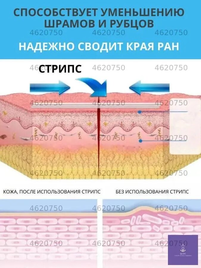 Компрессионная повязка — фото 1