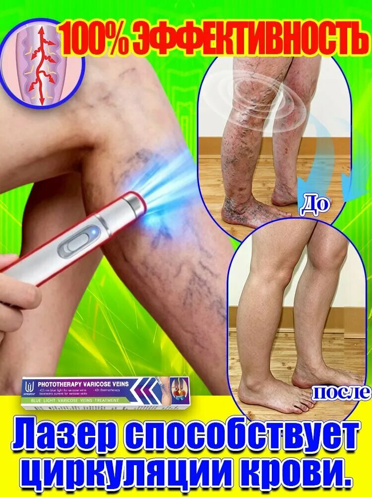 Варикозные вены. Устраняет тромбы, усталость ног и отеки. Способствует венозному кровообращению. Безболезненно и снимает усталость. Один лазерный аппарат.