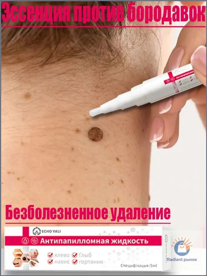 Супер-чистотел лосьон от бородавок, папиллом и родинок безболезненное удаление без рубцов. чистотел